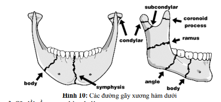 Gãy xương hàm dưới-2